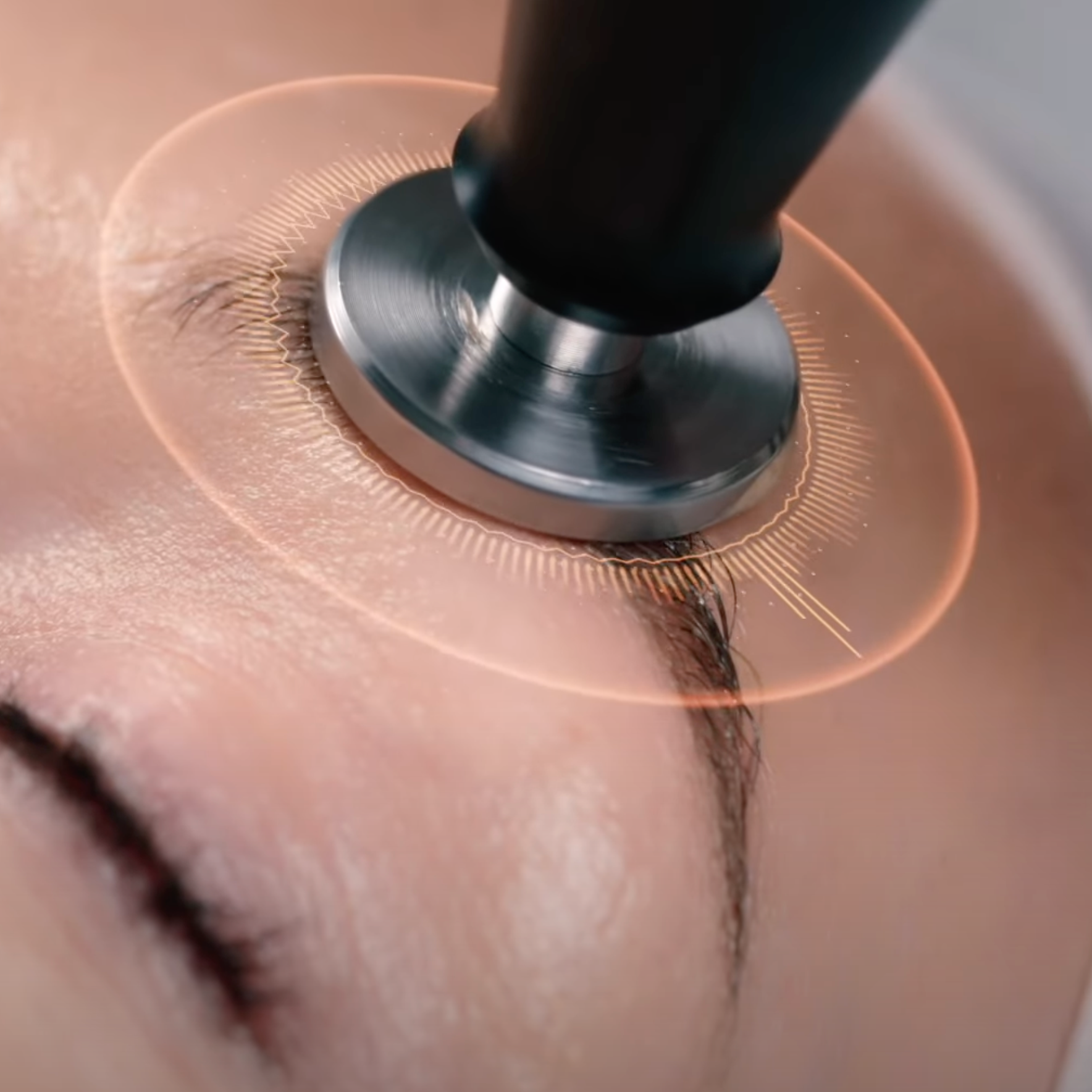 Microneedling with DF infusion – Nuvo MediSpa